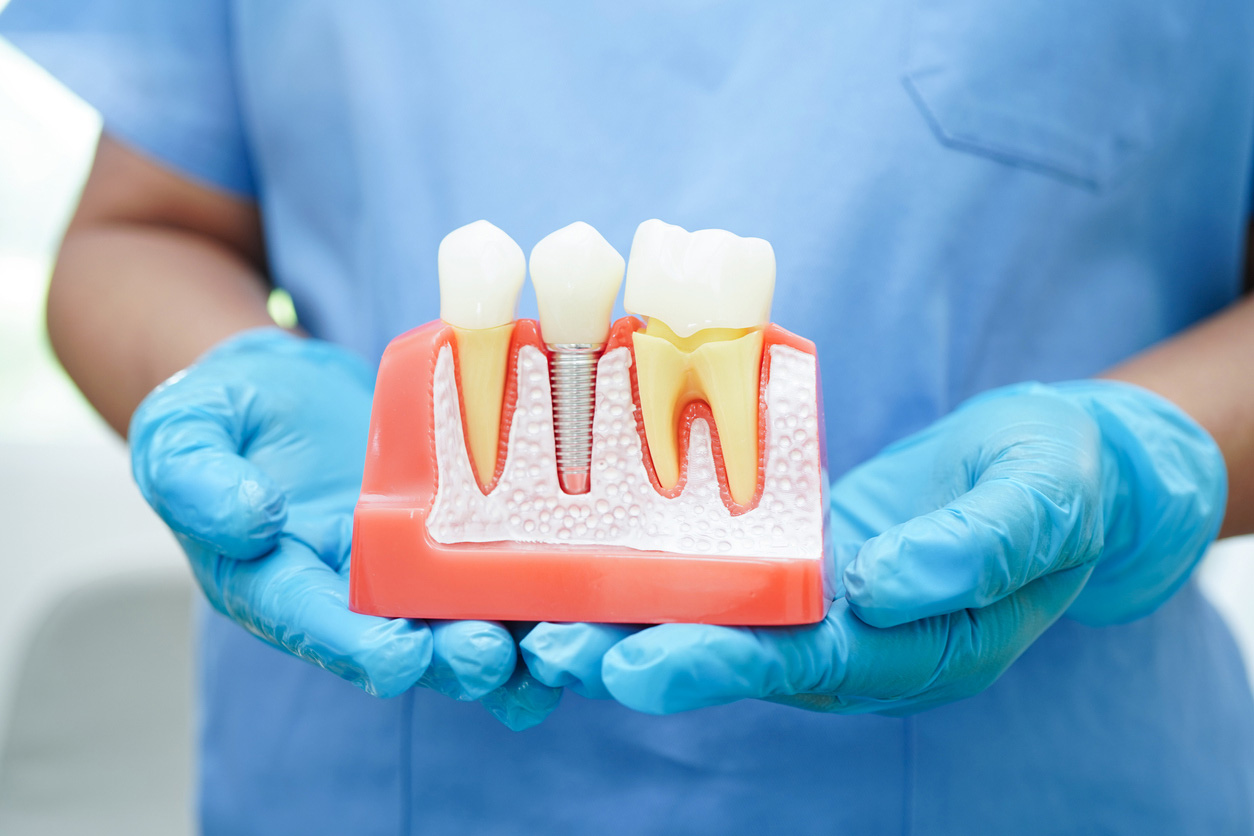 Learn About the Dental Implant Process | Sciota PA