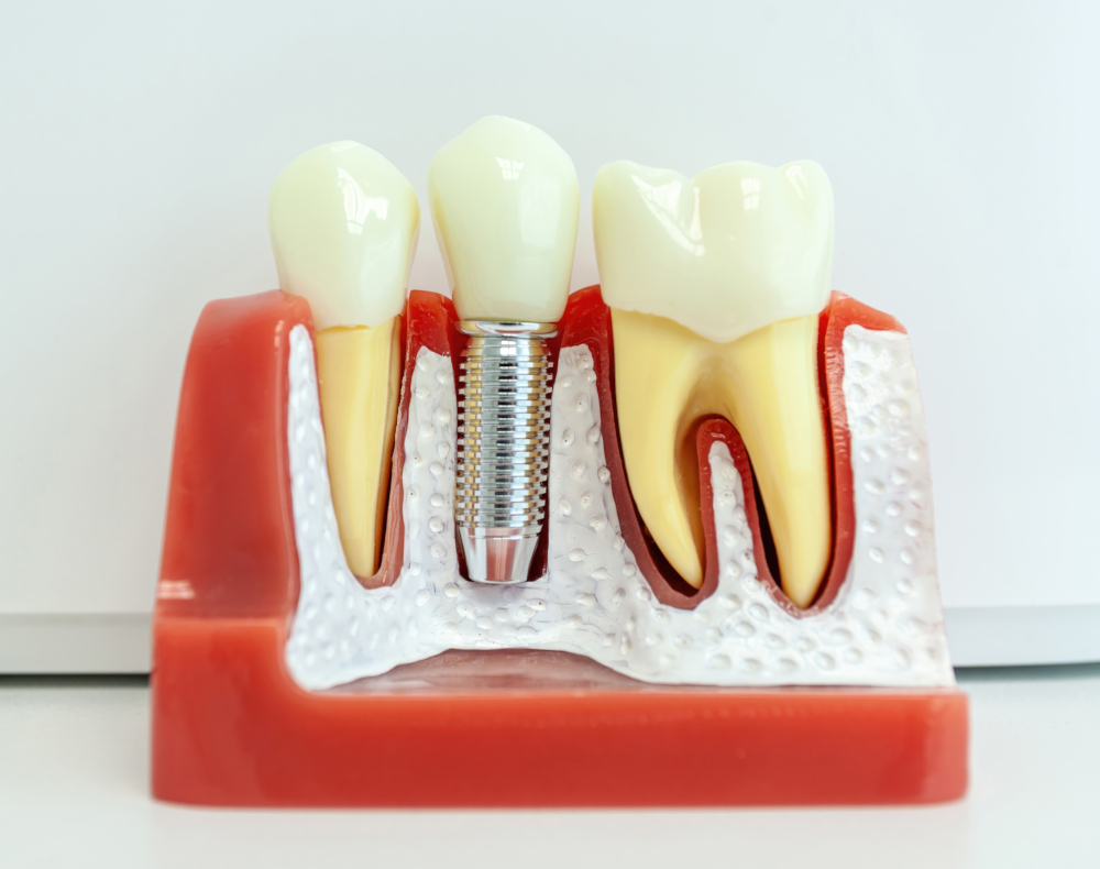 Moving from Dentures to Dental Implants: What You Should Know